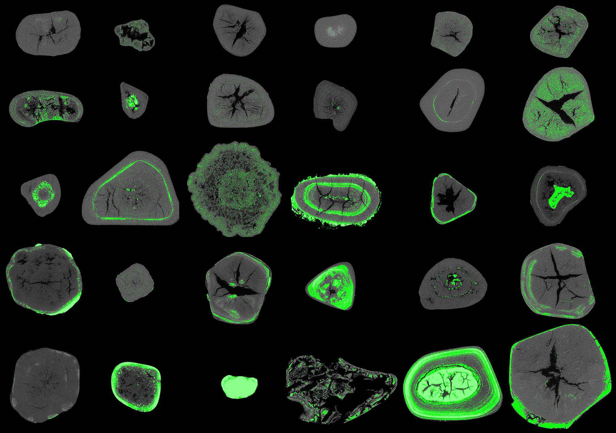 Discovering the secret of gallstones - Collaborative Research Centre 1181